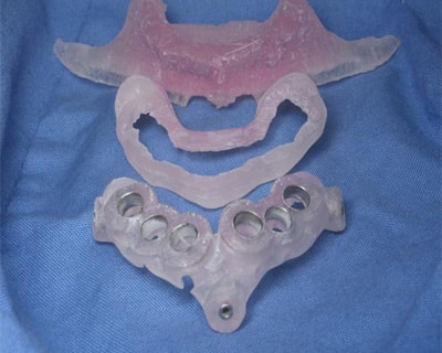 Computer Guided Surgery in Ft. Lauderdale | Dr. Leslie Sultan