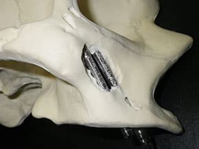 ZAGA ZYGOMA IMPLANTS - Sultan Center For Oral Facial Surgery