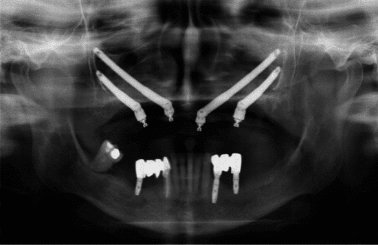 ZAGA ZYGOMA IMPLANTS - Sultan Center For Oral Facial Surgery