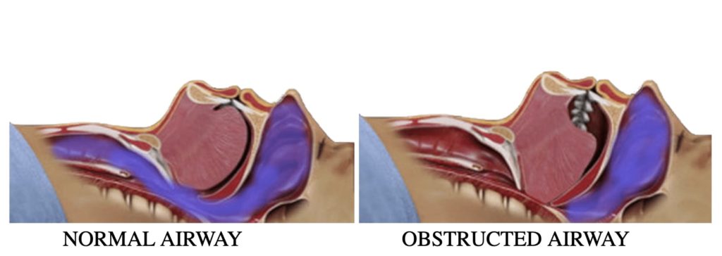 Snoring and Sleep Apnea Treatment in Fort Lauderdale