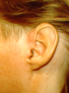 TMJ Surgery Fort Lauderdale - TMD Treatment Broward County