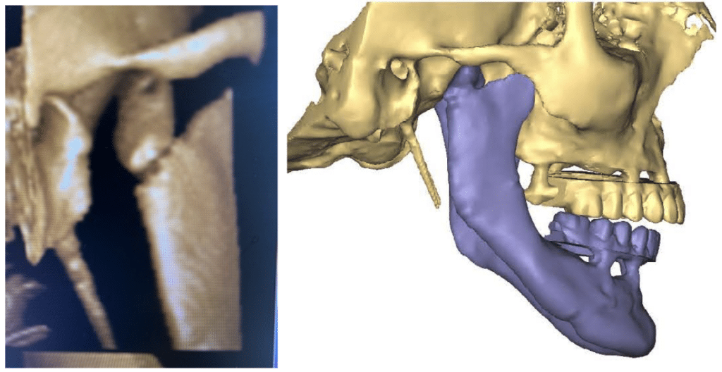 TMJ Surgery Fort Lauderdale - TMD Treatment Broward County