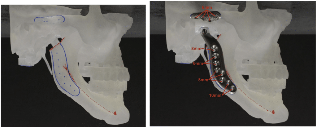 TMJ Surgery Fort Lauderdale - TMD Treatment Broward County