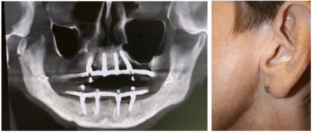TMJ Surgery Fort Lauderdale - TMD Treatment Broward County