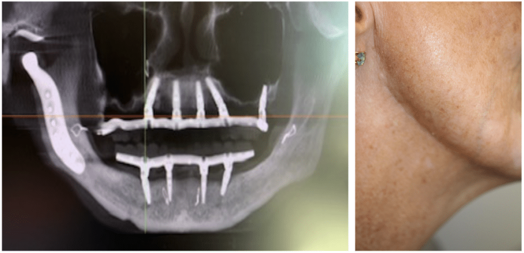 TMJ Surgery Fort Lauderdale - TMD Treatment Broward County