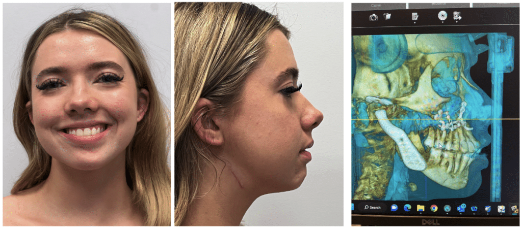 TMJ Surgery Fort Lauderdale - TMD Treatment Broward County